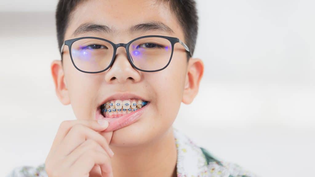 First Days in Braces – Sterling Endodontics